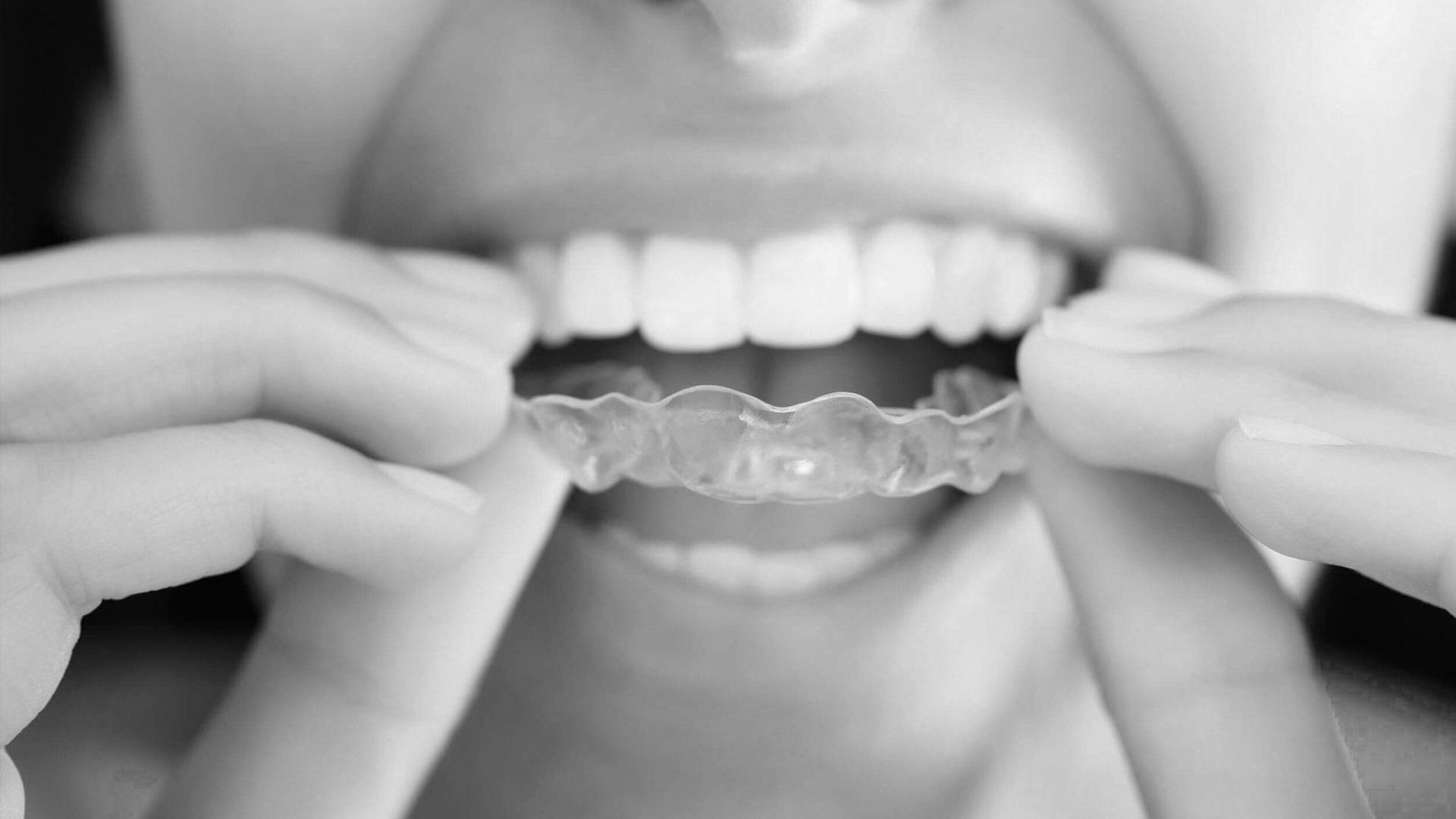 Tratamientos Bruxismo - Dra. Yen Palma